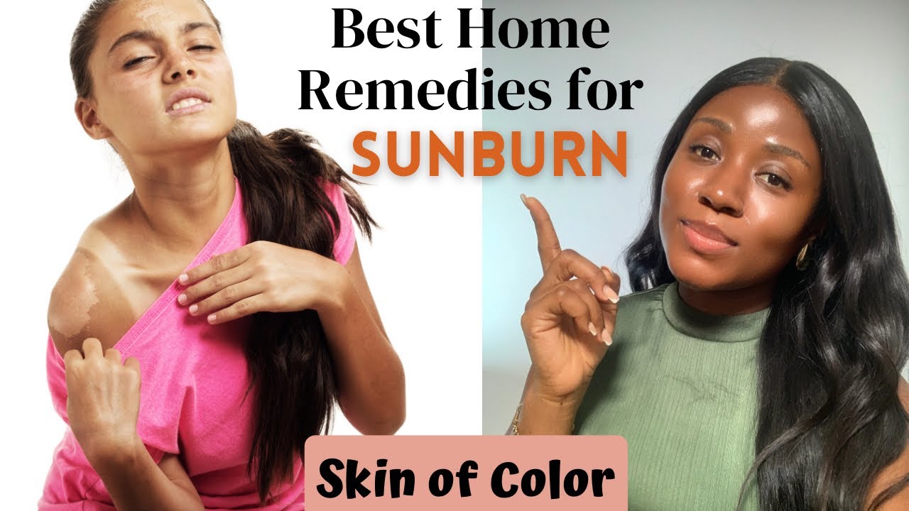 Sunburn Skin Treatment at home || Sunburn Treatment for Skin of Color # ...