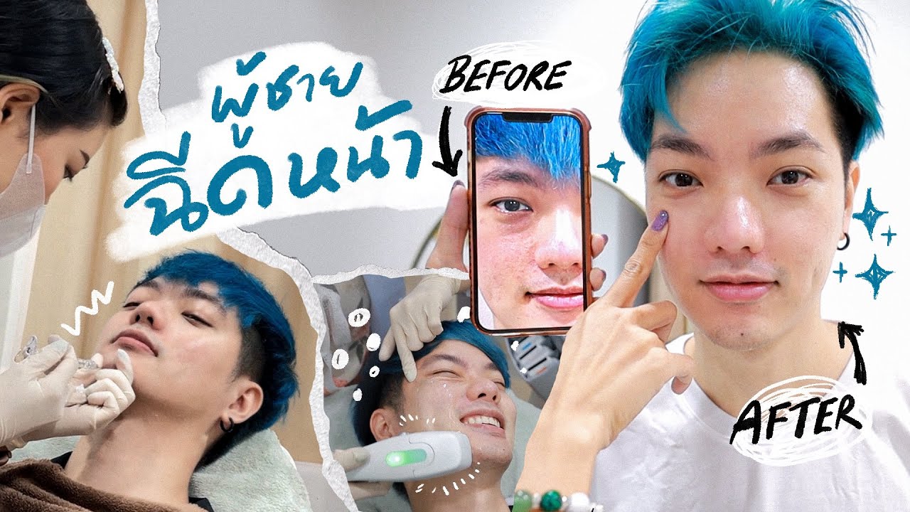 โดนเปิดซิง(หน้า) เจ็บมั้ย? ผู้ชายฉีดหน้าเรียว รีวิวจัดเต็ม!! | Here's ...