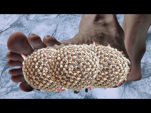 ASMR Animation Treatment Infected Foot 🦶,, Deep Cleaning 2D Animation ...