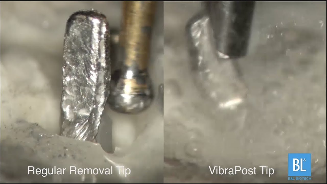 Use This To Remove Posts Faster For Dental Treatment. - YouTube