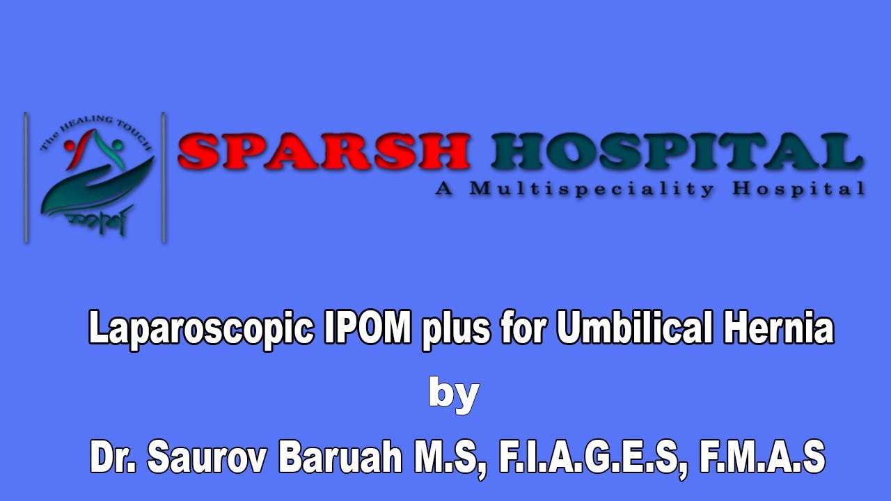 Laparoscopic IPOM-Plus Umbilical Hernia Repair - YouTube