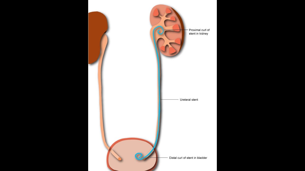 Ureteric DJ stenting in transplant kidney who failed retrograde ...