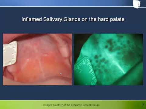 Abnormal Mucosa As Viewed with the VELscope Vx - YouTube