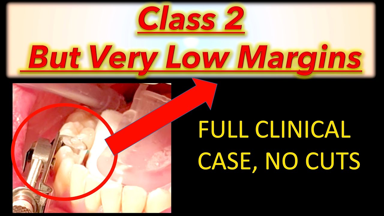 Full Case without Rubber Dam: Class II Composite Restoration, BEST TIPS ...