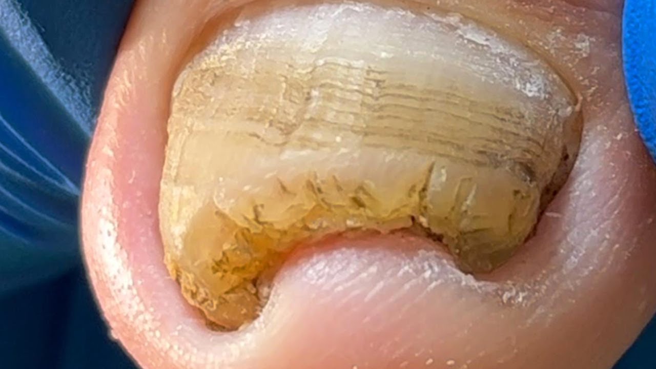 Swelling Of Toes And Deformation Of Ingrown Toenails【Xue Yidao】 - YouTube