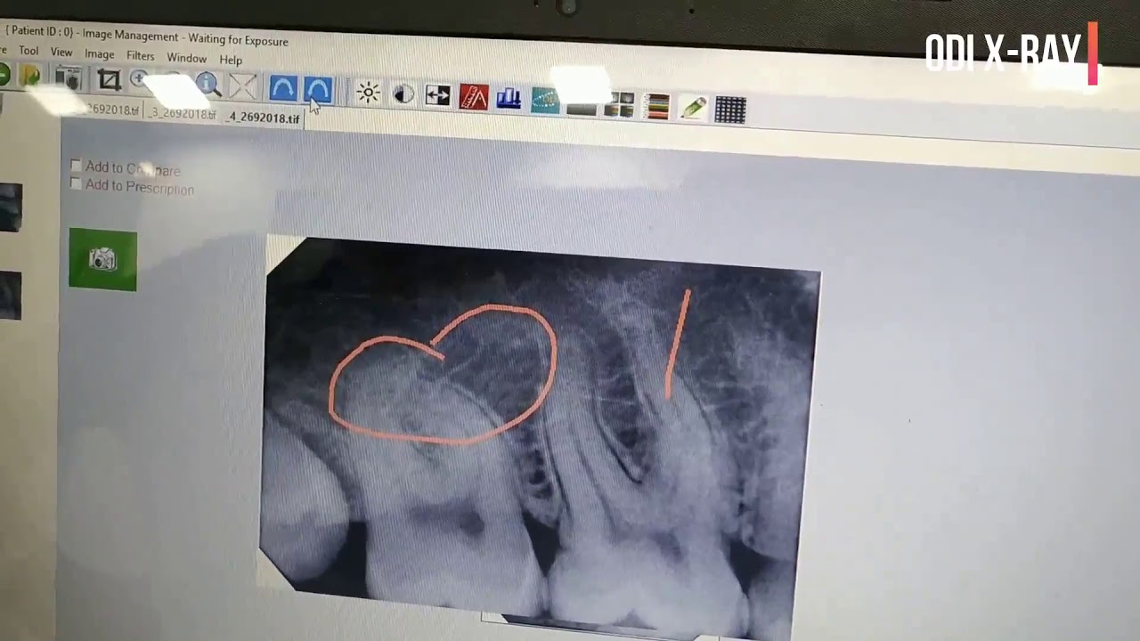 ODI HD Dental Sensor Demo - YouTube