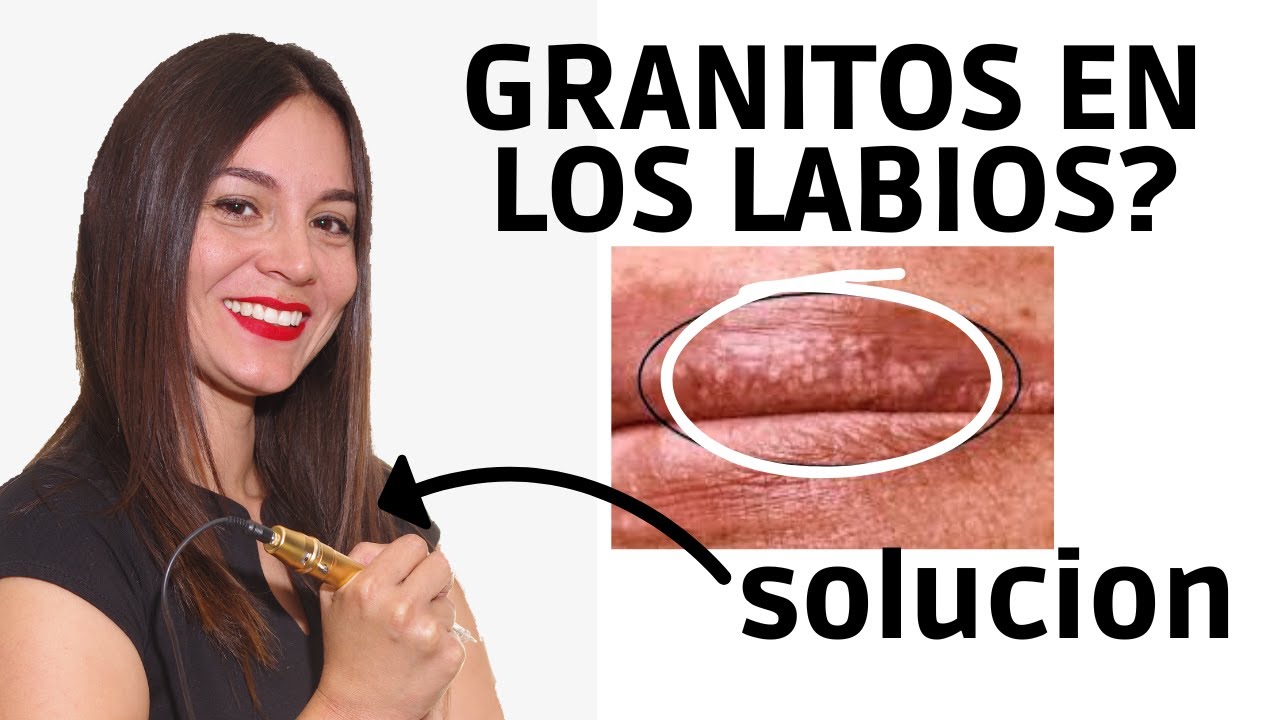 ¿granos o manchas blancas o amarillentas en los labios? te cuento como ...