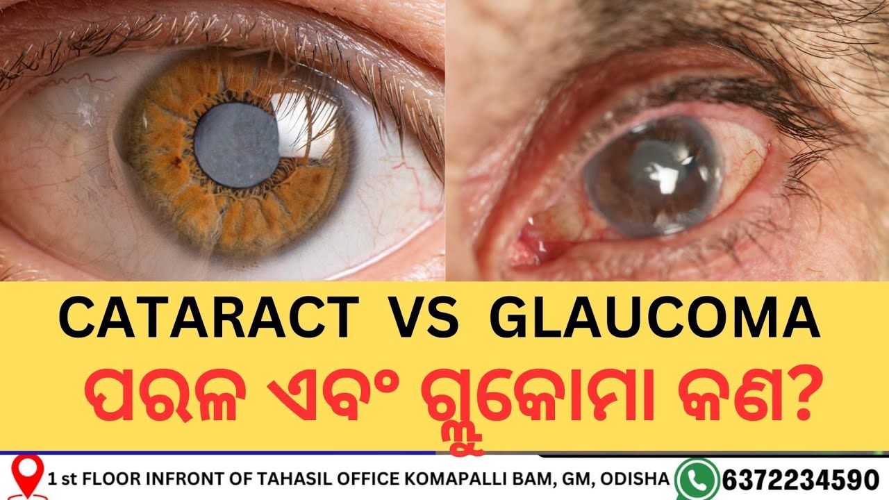 Cataract vs glaucoma?what is the difference between glaucoma and ...