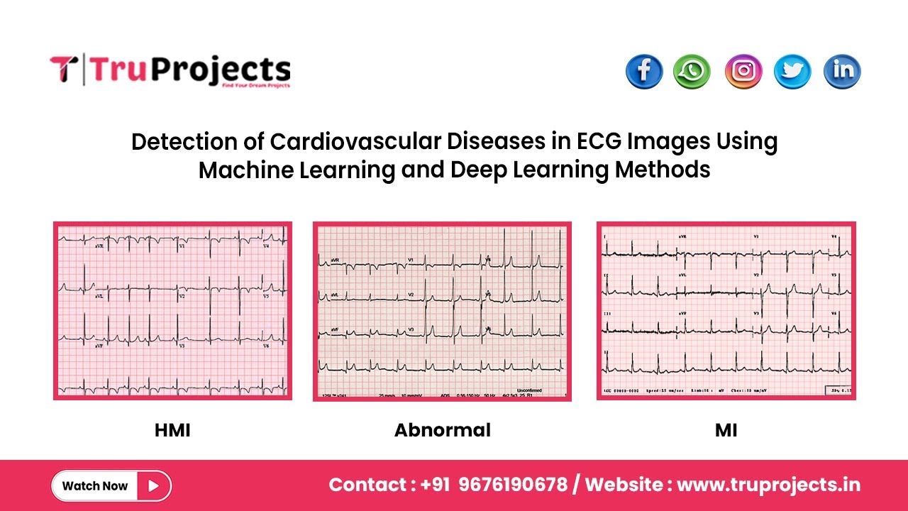 Detection of Cardiovascular Diseases in ECG Images Using Machine ...