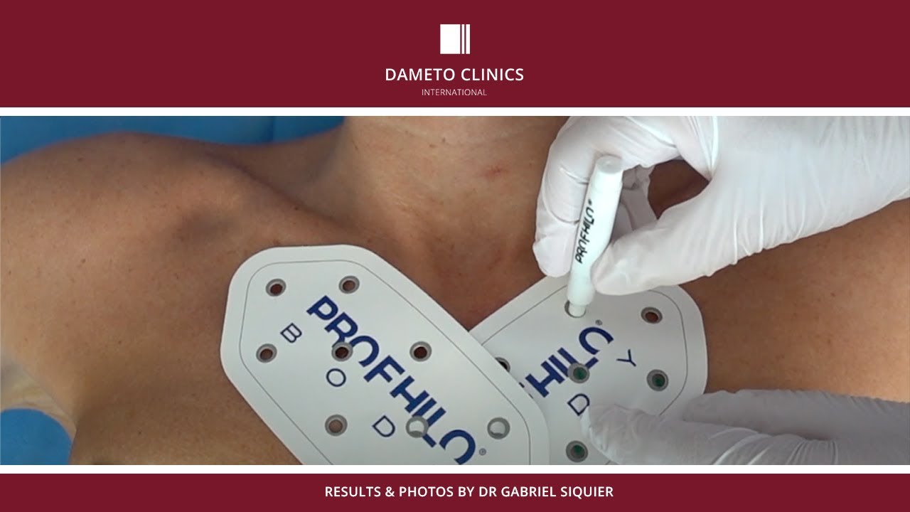 Profhilo Body 15 points decolleté technique by Dr. Gabriel Siquier ...