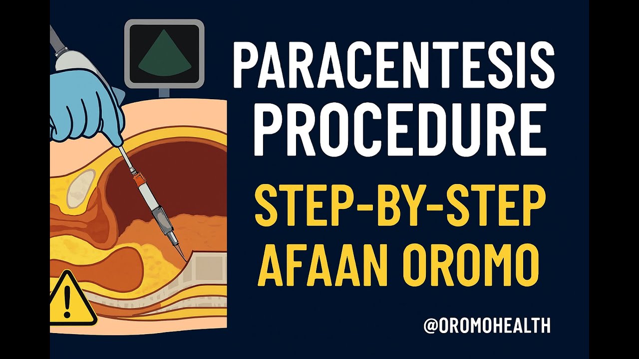 Step-by-Step Guide to Performing Paracentesis Procedure by Afaan Oromoo ...