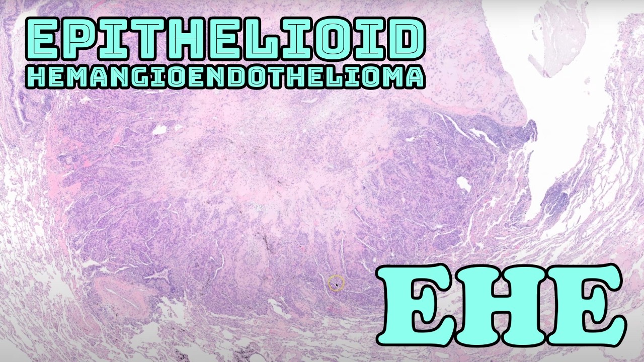 Rare Lung Cancer/Tumor: Epithelioid Hemangioendothelioma (EHE) vascular ...