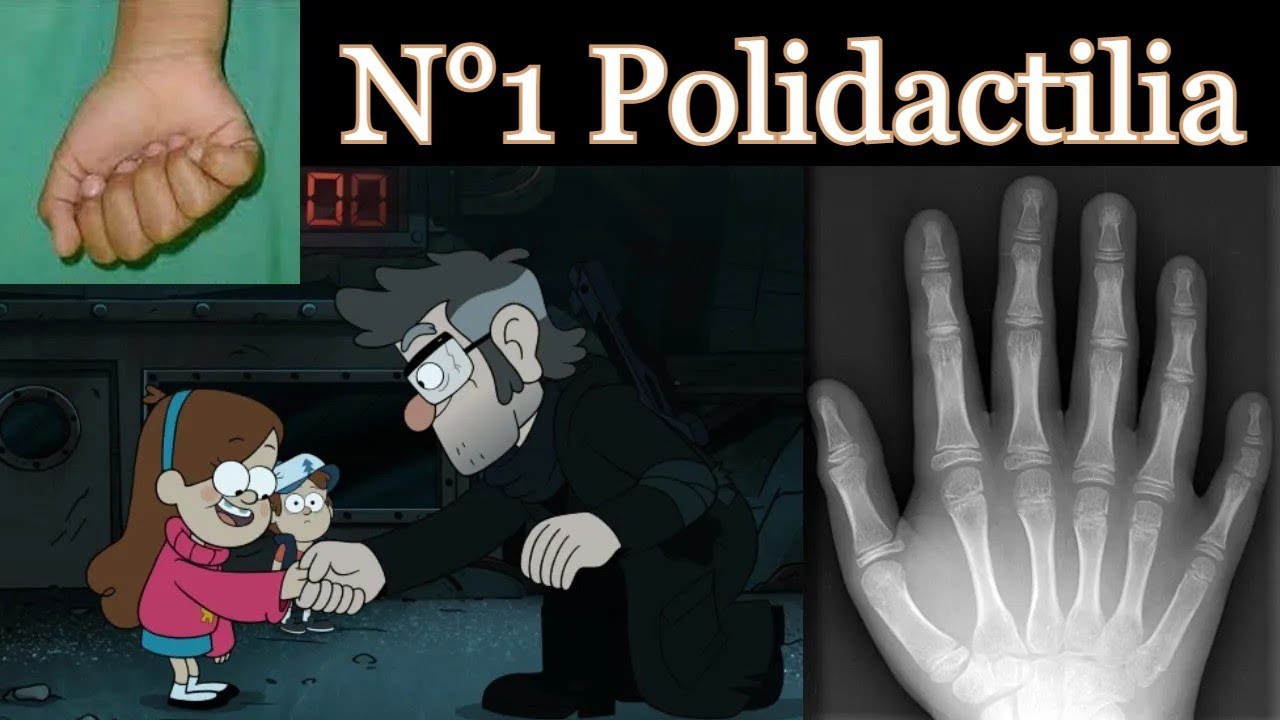 N°1 Polidactilia o personas que nacen con seis dedos o más. - YouTube