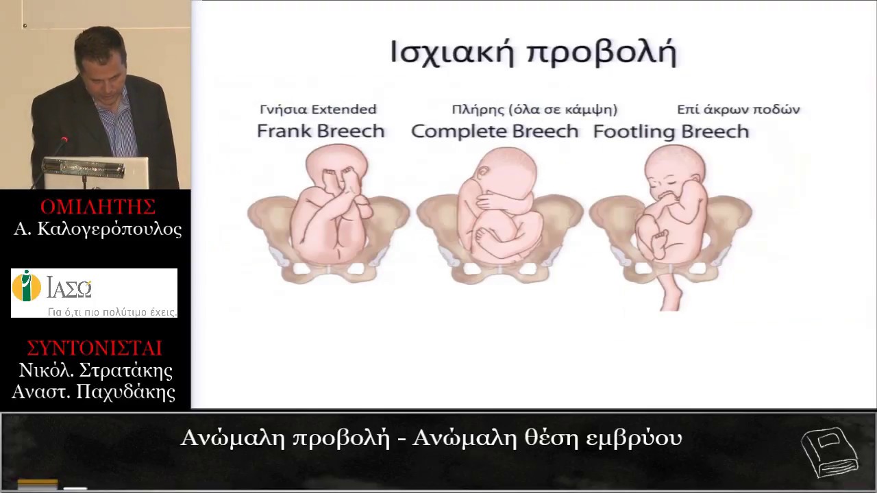 Ανώμαλη προβολή - Ανώμαλη θέση εμβρύου - Αλέξανδρος Καλογερόπουλος ...