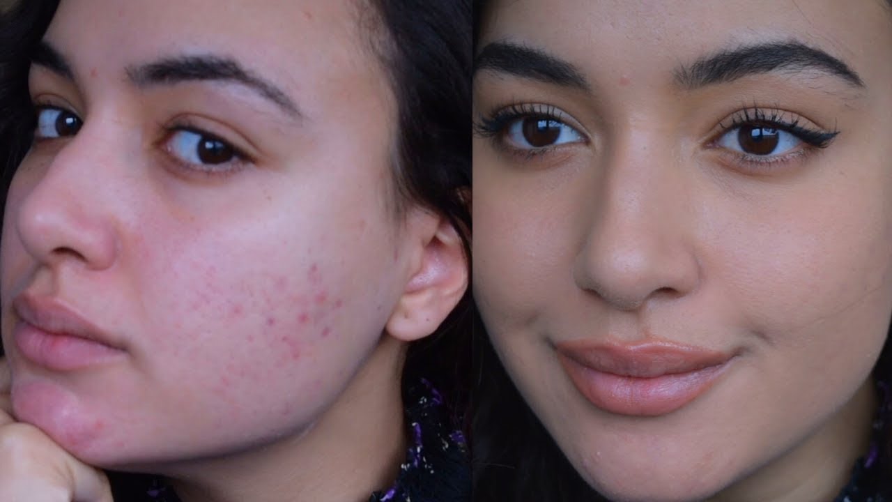 HOW TO LIGHTLY COVER ACNE MARKS WITH BAREMINERALS POWDER FOUNDATION ...