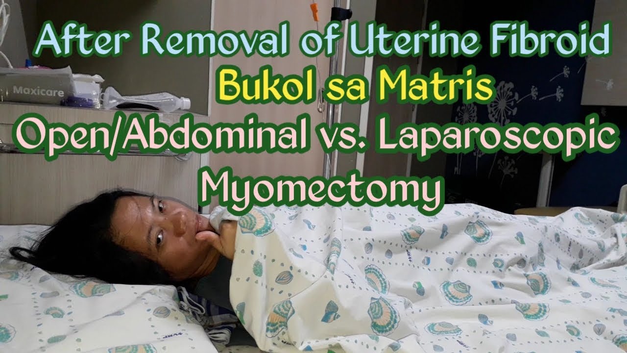 Uterine Fibroid/Bukol sa Matris |Experience and Advise - YouTube