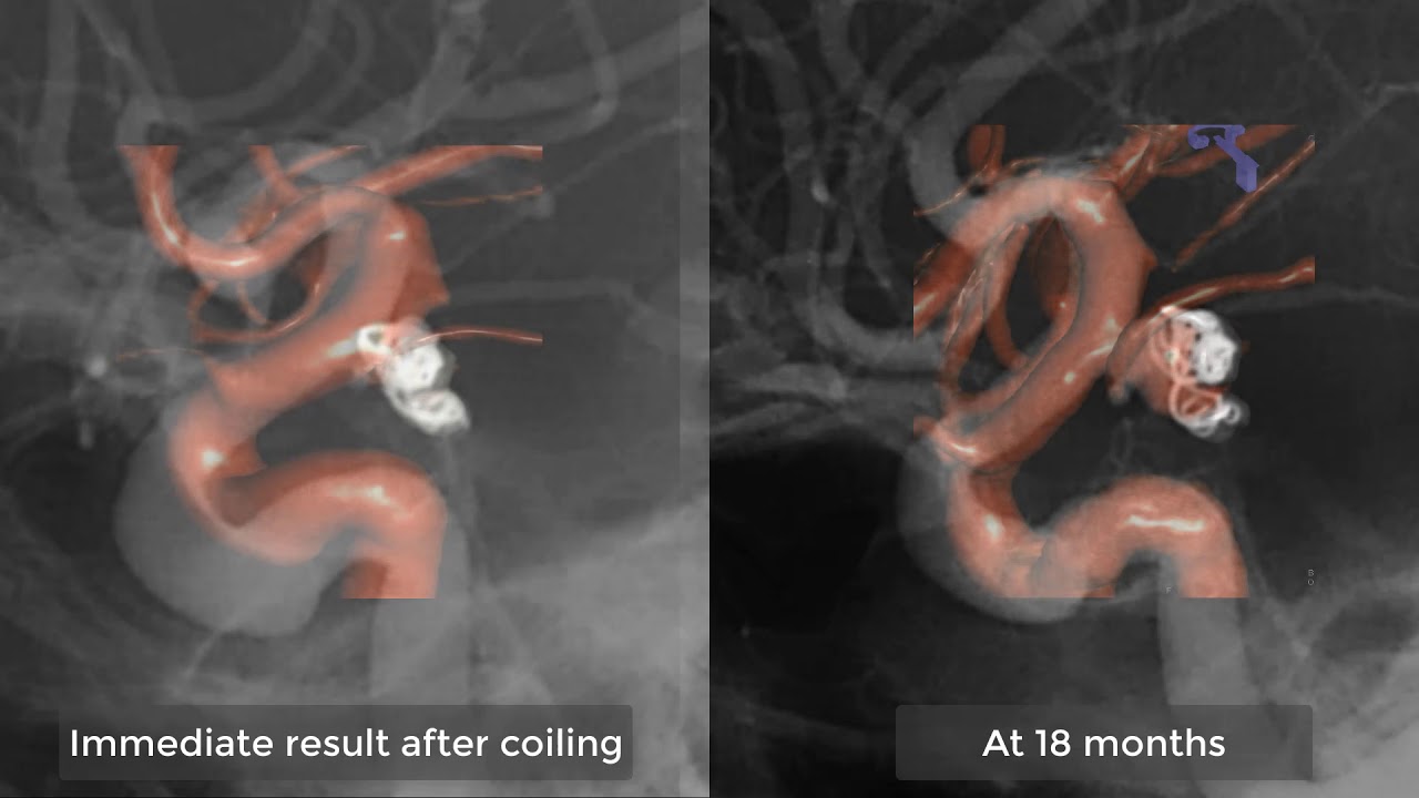 RECURRENT RIGHT PCom ANEURYSM - FLOW DIVERTER TREATMENT - YouTube