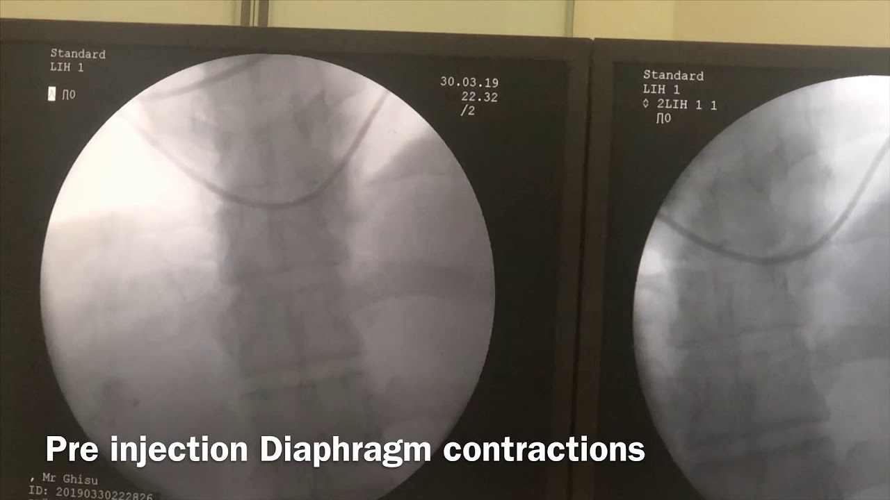 USG guided Phrenic nerve block for intractable hiccups - YouTube