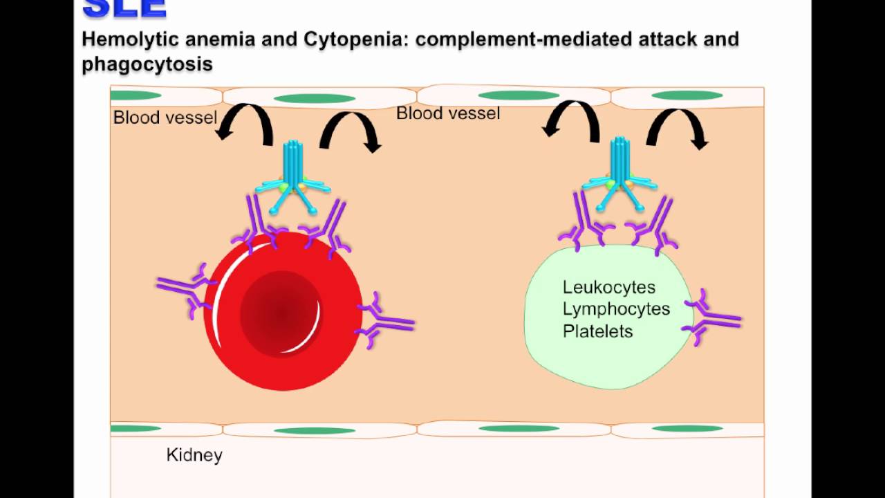 Systemic Lupus erythematosus (SLE) 2016 - YouTube