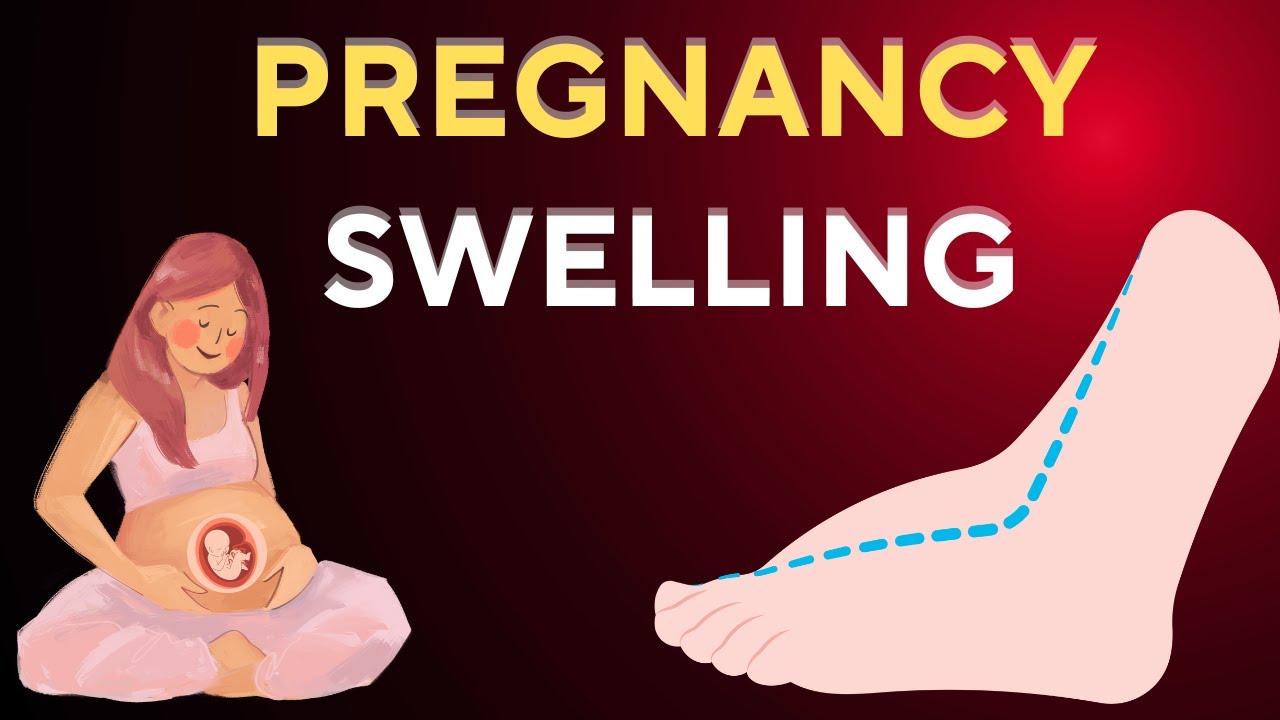 Pregnancy Swelling: Causes, Prevention, and Remedies - YouTube
