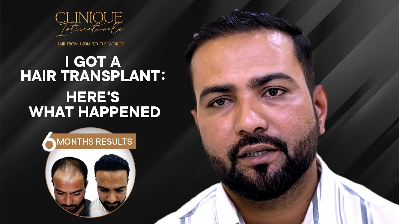 The End of Hair Loss: REAL PATIENT, AMAZING RESULTS! - YouTube