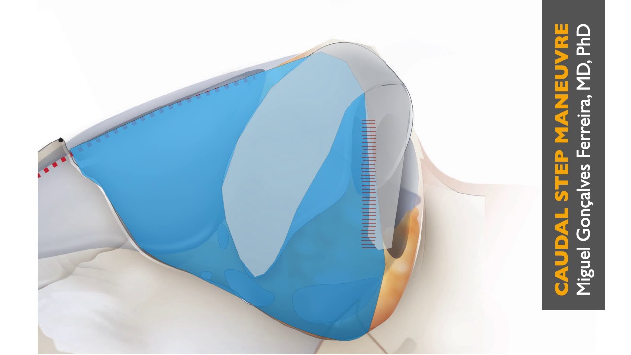 CAUDAL STEP MANEUVER - Miguel Goncalves Ferreira, MD, PhD - YouTube