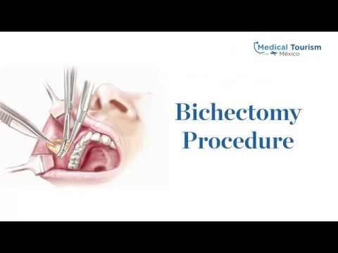 Bichectomy procedure - Medical Tourism Mexico - YouTube
