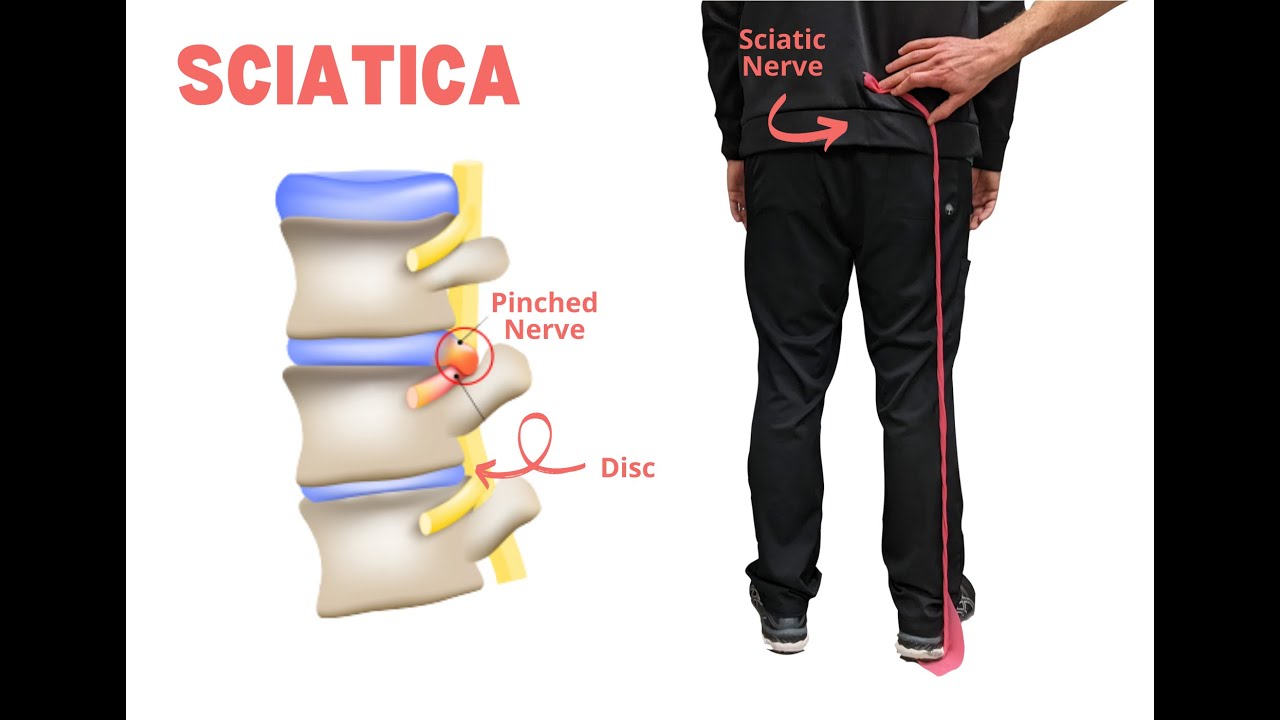 Understanding Sciatic Nerve Tension - YouTube