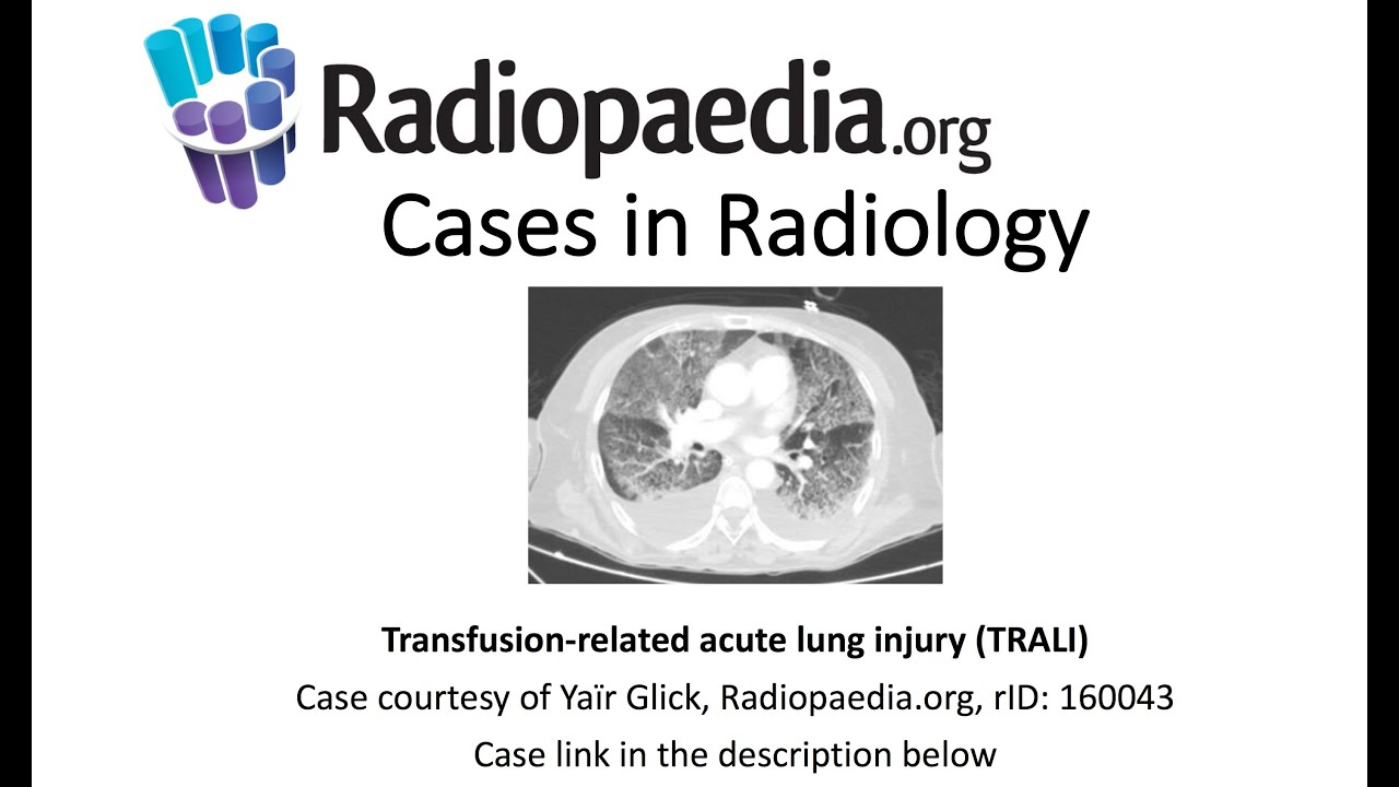 Transfusion-related acute lung injury (TRALI) (Radiopaedia.org) Cases ...