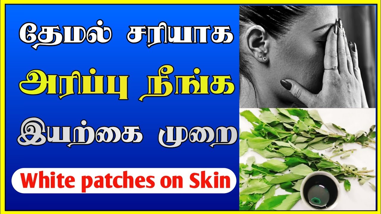 தேமல் சரியாக | Themal skin disease | White patches on Skin | Tamil ...