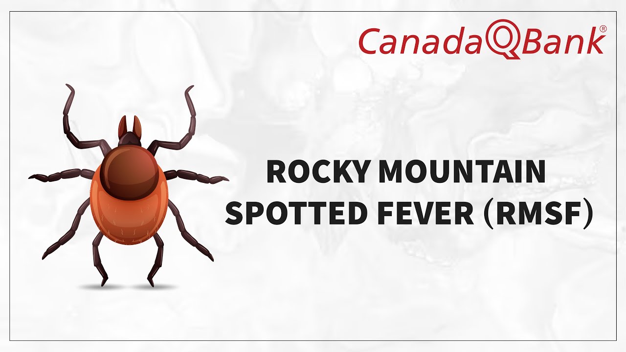 Rocky Mountain Spotted Fever (RMSF): Symptoms, Diagnosis & Treatment ...
