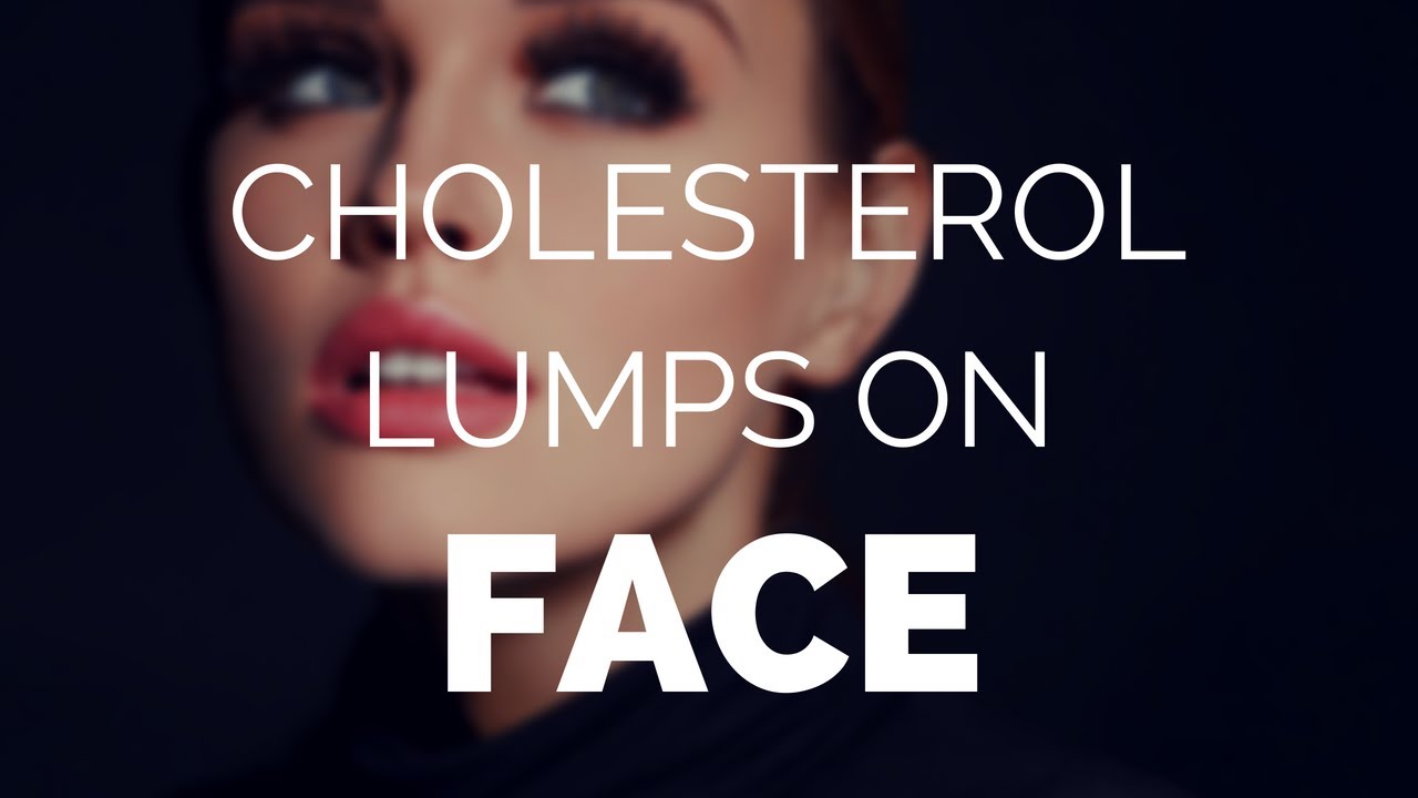 Cholesterol lumps on face. What they are and how to remove them. - YouTube