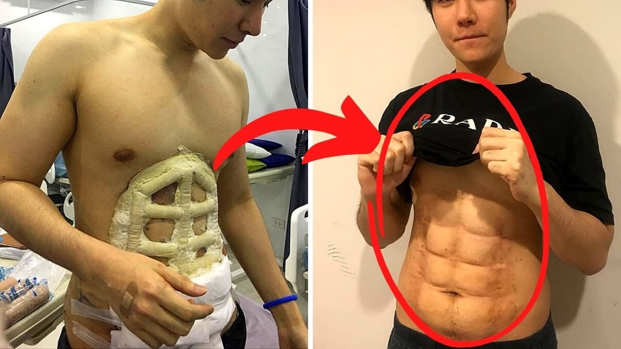 This Cosmetic Clinic Is Offering An Instant 6 Pack Surgery Option - YouTube