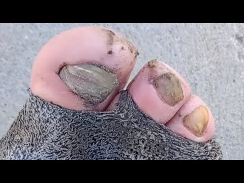 Daniel Larson Demands Compensation From Bob For His Trench Foot - YouTube