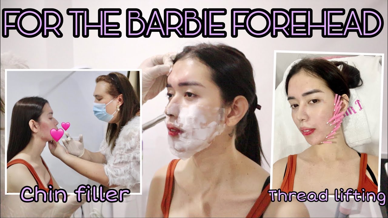 BARBIE FOREHEAD + CHIN AUGMENTATION + THREAD LIFTING + BOTOX BUUUGSH ...