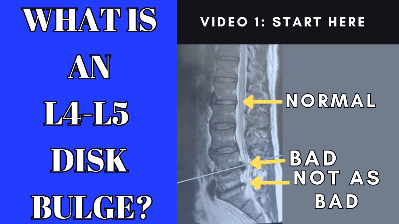 What Is An L4-L5 Disc Bulge And Why It Hurts So Much | Dr Gregory ...