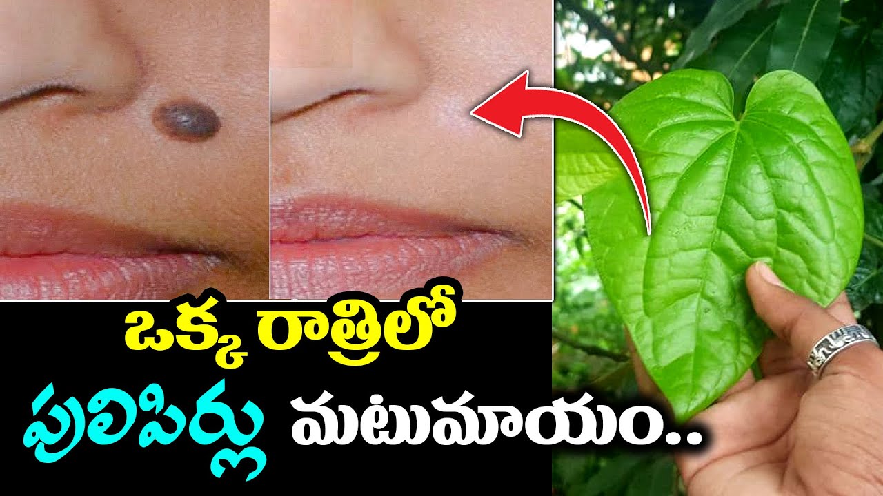 కేవలం ఒక్క రోజులోనే పులుపిర్లు పూర్తిగా రాలిపోతాయి || Pulipuri ...