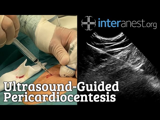 Pericardiocentesis Ultrasound Guided