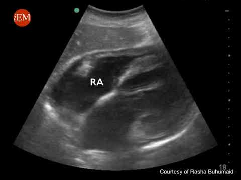 Video 3 Subxiphoid view demonstrating pericardial effusion with ...