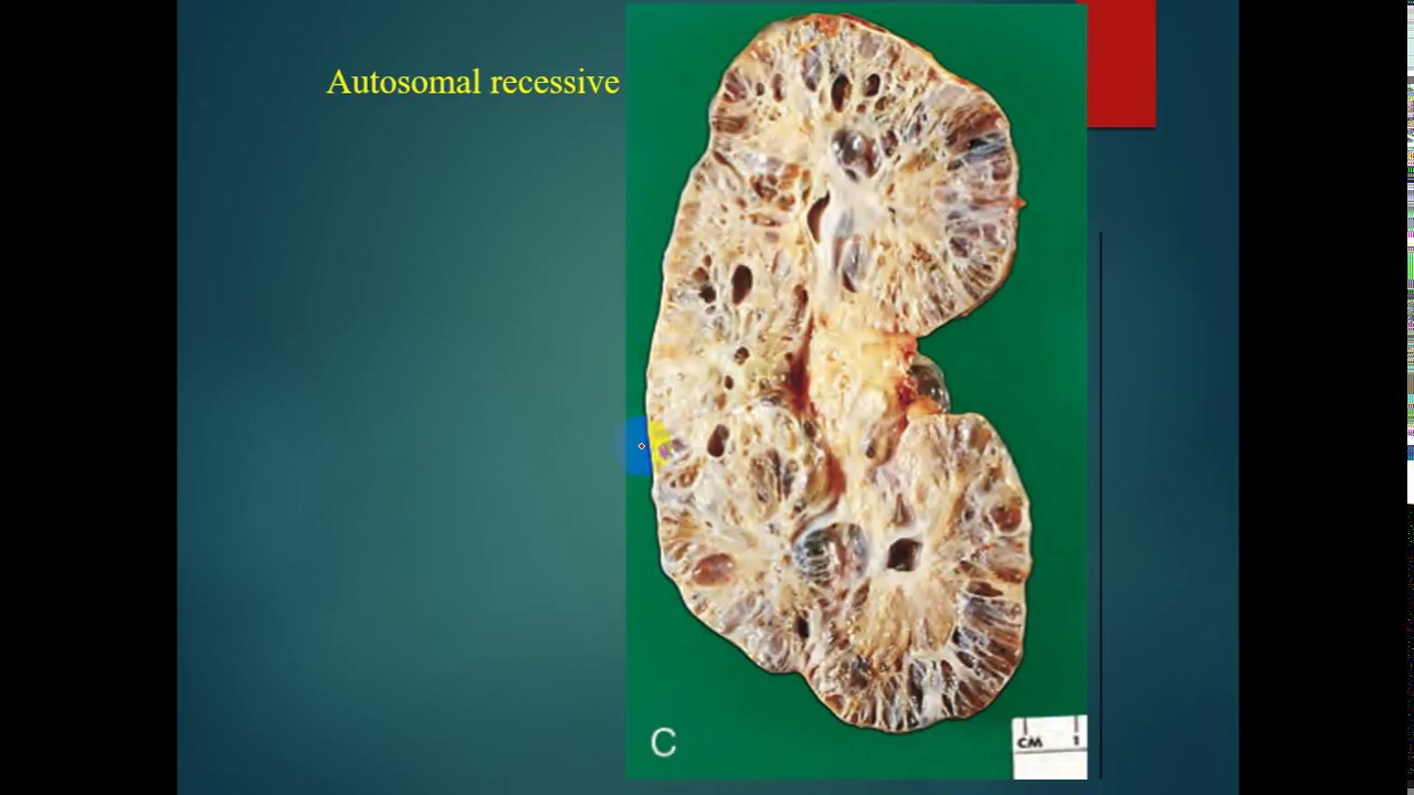 Patho - dr. Tahseen -- Polycystic Kidney ( Adult & Infantile ...