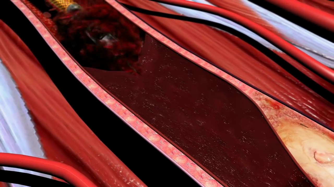 ROTAREX®S by Straub Medical AG - YouTube