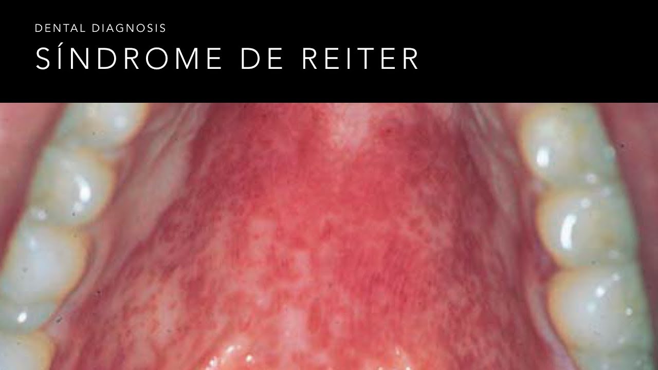 Síndrome de Reiter - YouTube