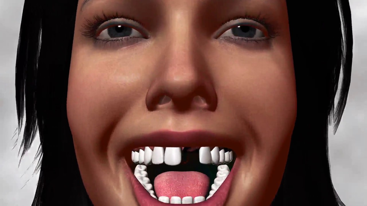 Dental Implant Animation by Digimax Dental - YouTube
