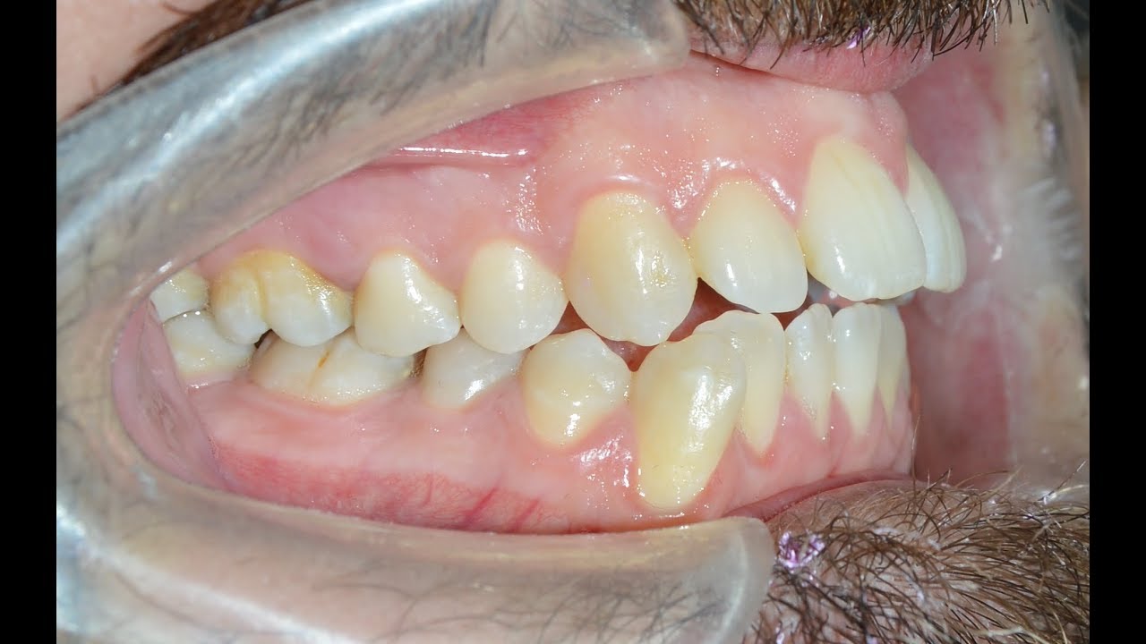 Orthodontic treatment of incomplete overbite case with the help of mini ...