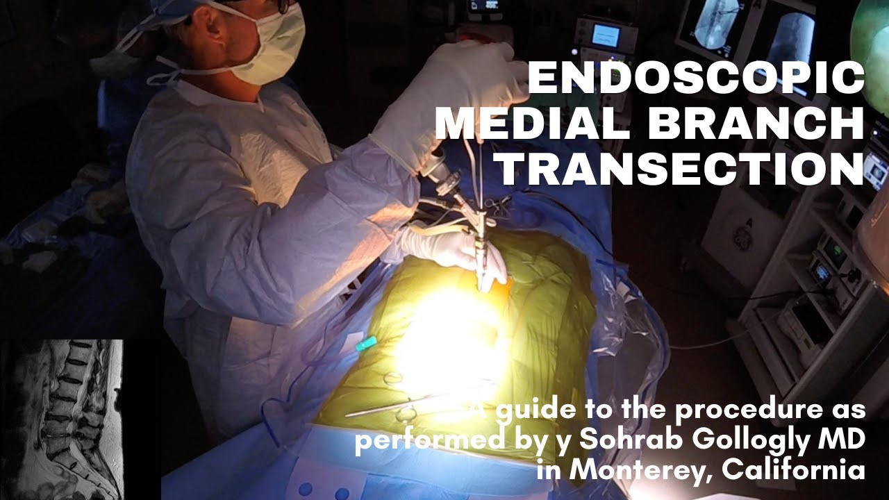 Endoscopic Medial Branch Transection for painful facet arthritis in the ...