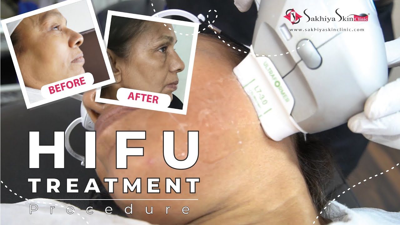 Laser Skin Tightening Treatment Hifu Procedure Dr Jagdish Sakhiya