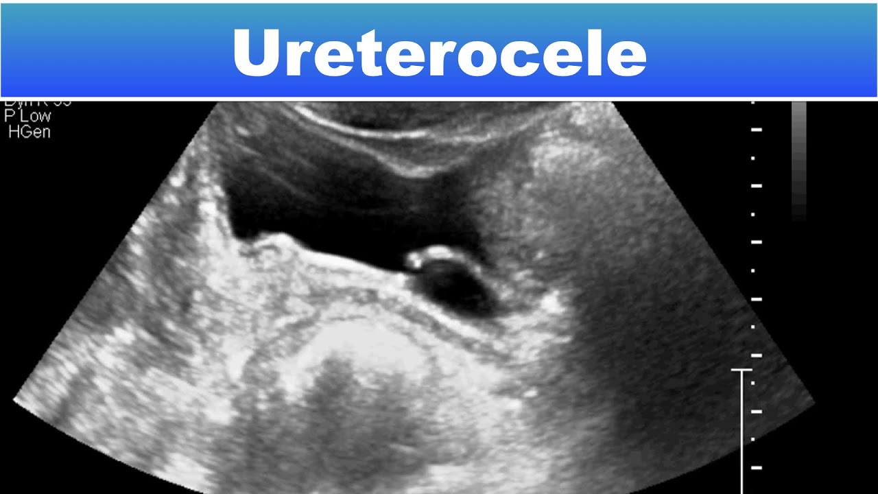 Ureterocele I Ultrasound - YouTube