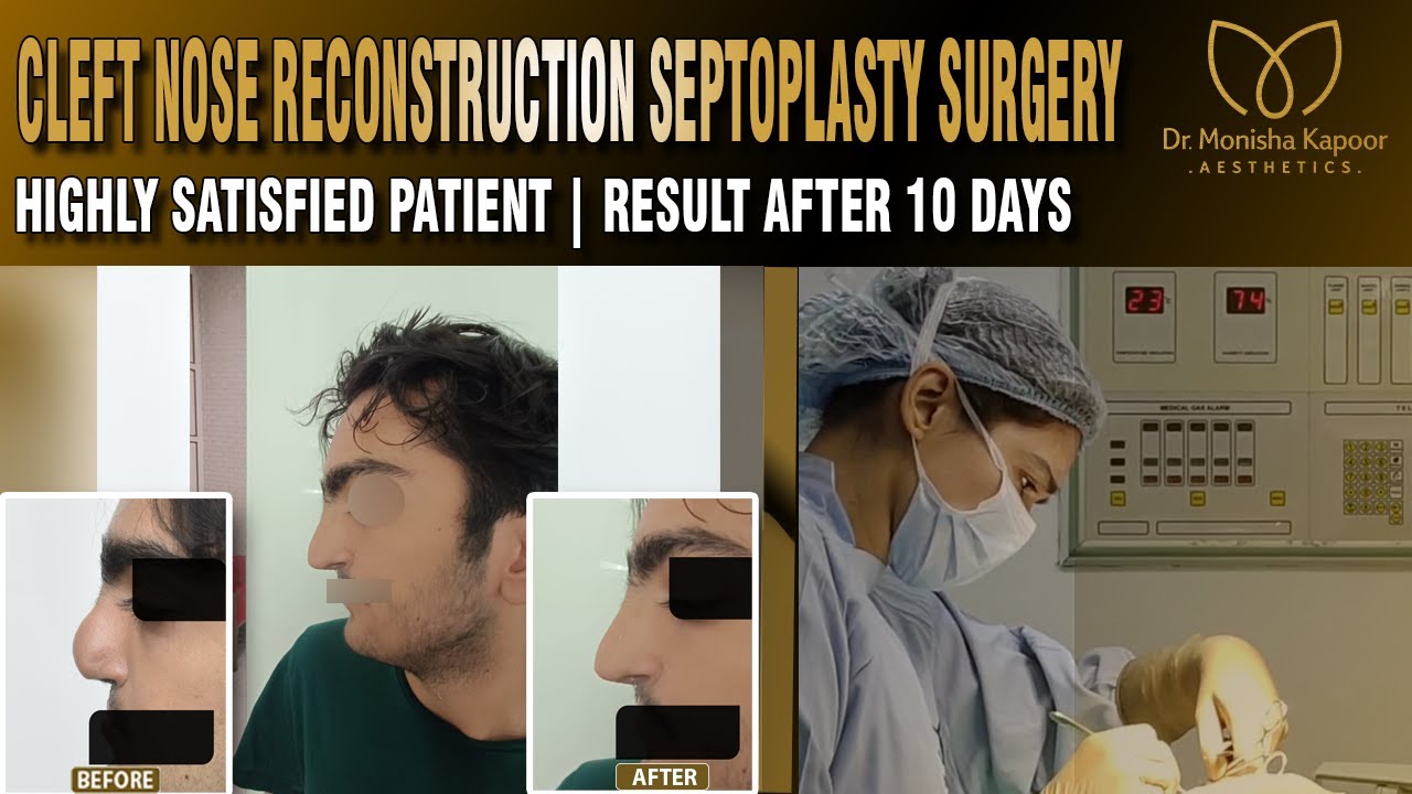 Cleft Nose Reconstruction and Septoplasty Delhi, India (Nose Job By- Dr ...