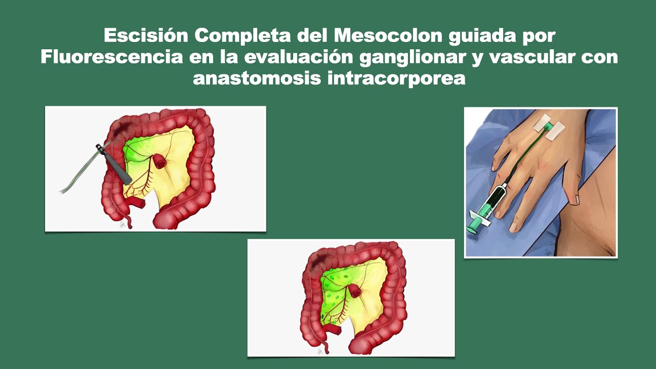 Escision Completa del Mesocolon guiada por fluorescencia en la ...