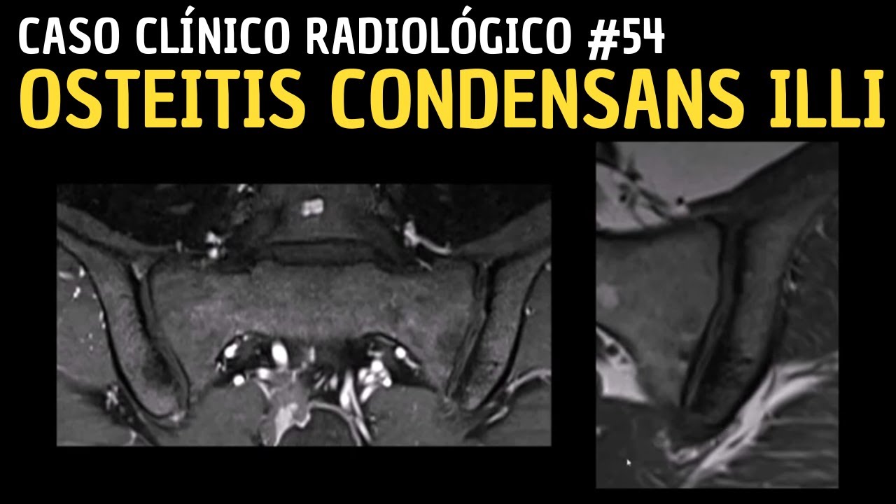 Caso Clínico Radiológico 54: Osteitis Condensans Illi. - YouTube